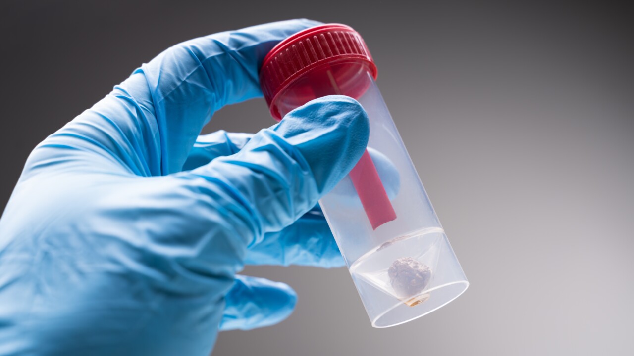 Avhandling: Ämne i avföring inte alltid kopplat till tarmsjukdom