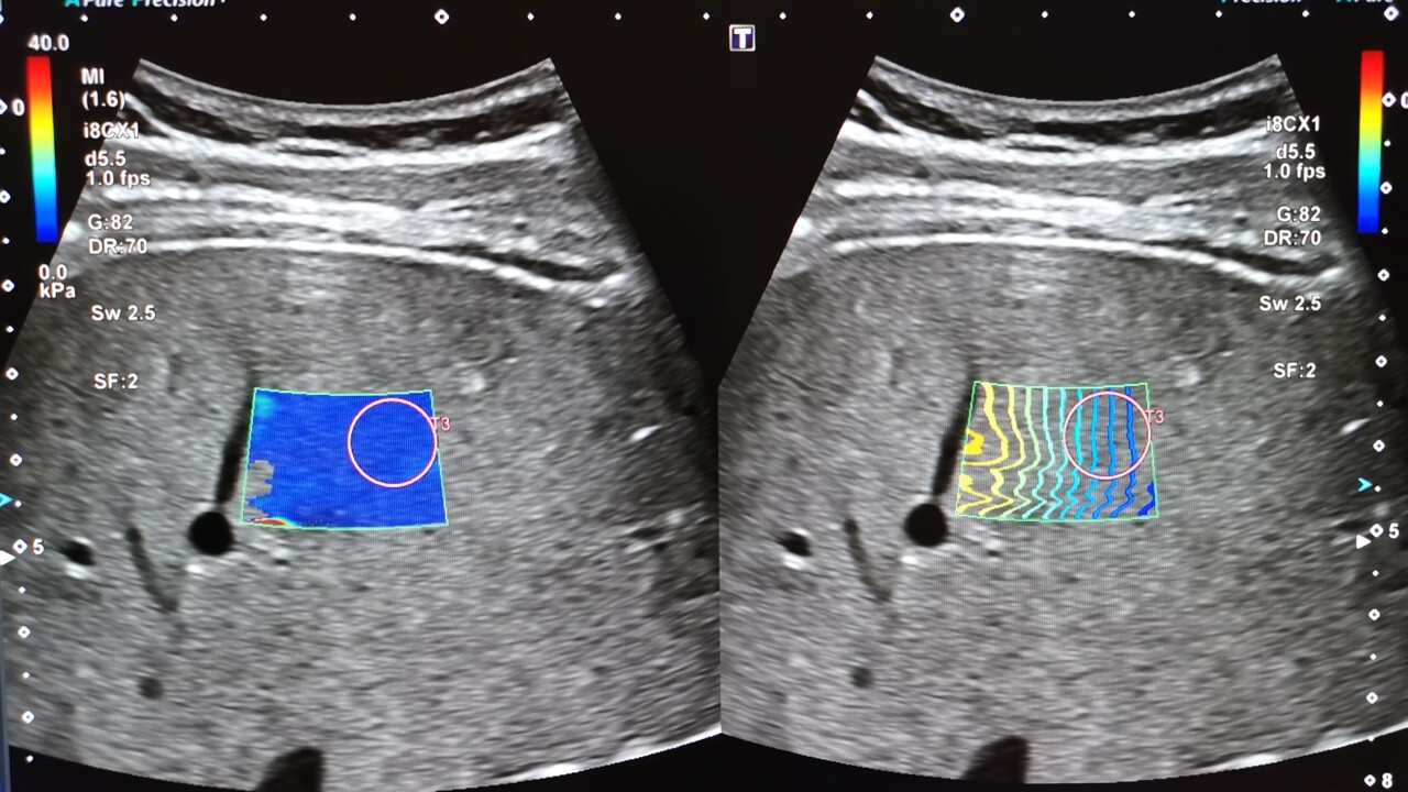 Leverelastografi med ultraljud tillförlitlig metod vid utvärdering av ...
