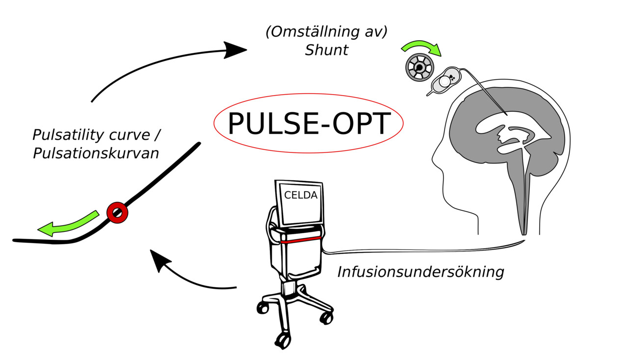 Individual treatment optimization for normal pressure hydrocephalus